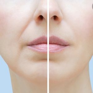 Epielle | Skincare | Smile Line Lifting Patch Hydrogel 8 Patchesnew ...